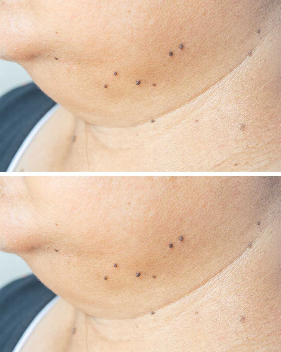 10 easy home remedies to get rid of skin tags and plantar warts